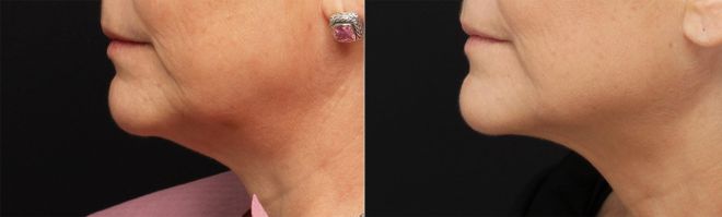 Profound – Before and After Results | Contour Dermatology