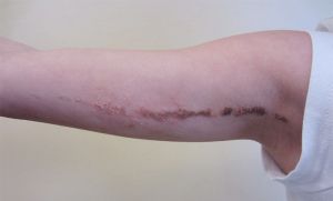 Epidermal Nevus | Skin Condition | Contour Dermatology