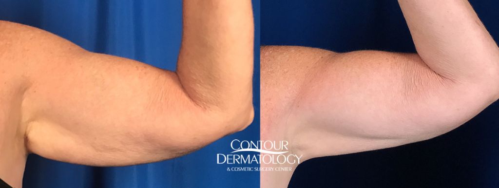 Coolsculpting for the Arms | Contouring for Flabby Arms
