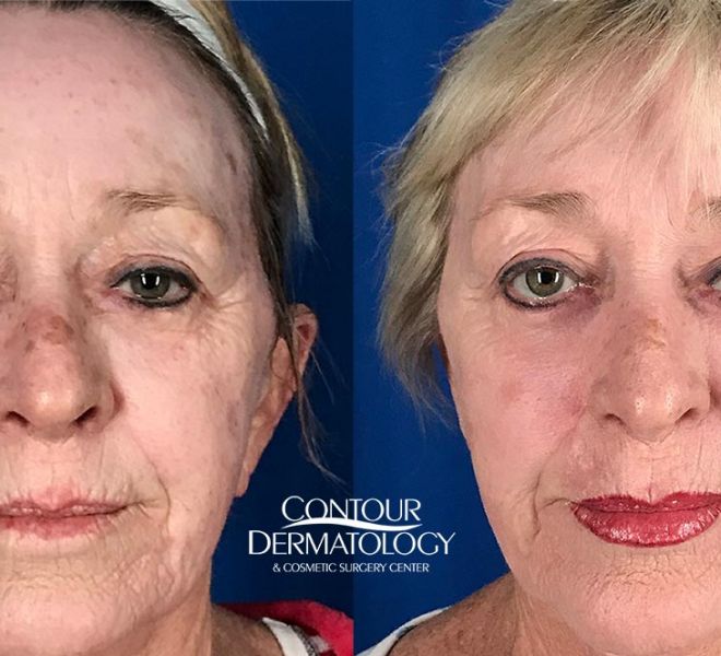 Fractional CO2 Laser Photo Gallery | Contour Dermatology