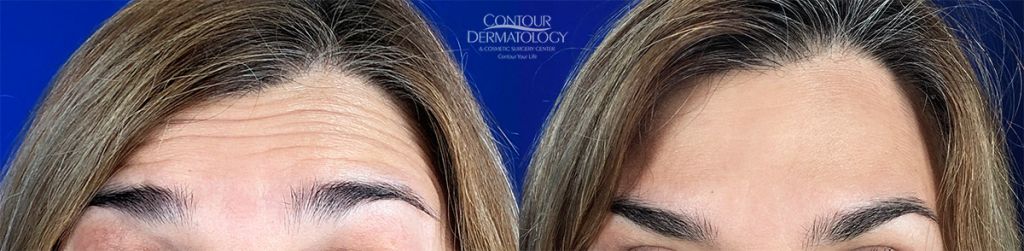Glowtox - A Beautiful Combo | Contour Dermatology