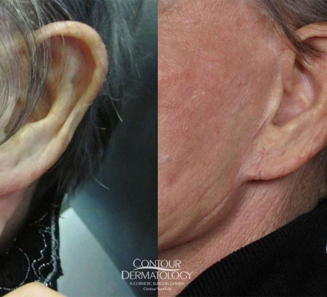 Earlobe Repair | Palm Desert | Palm Springs