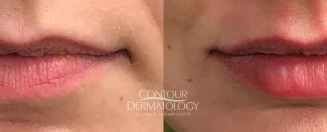 Restylane Kysse | Before After Photos | Enhance Lip Volume